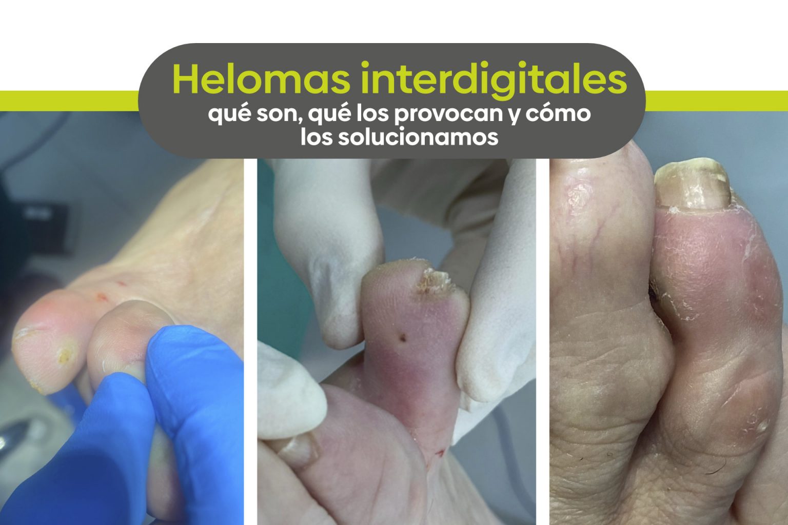 Helomas interdigitales: qué son, qué los provocan y cómo los ...